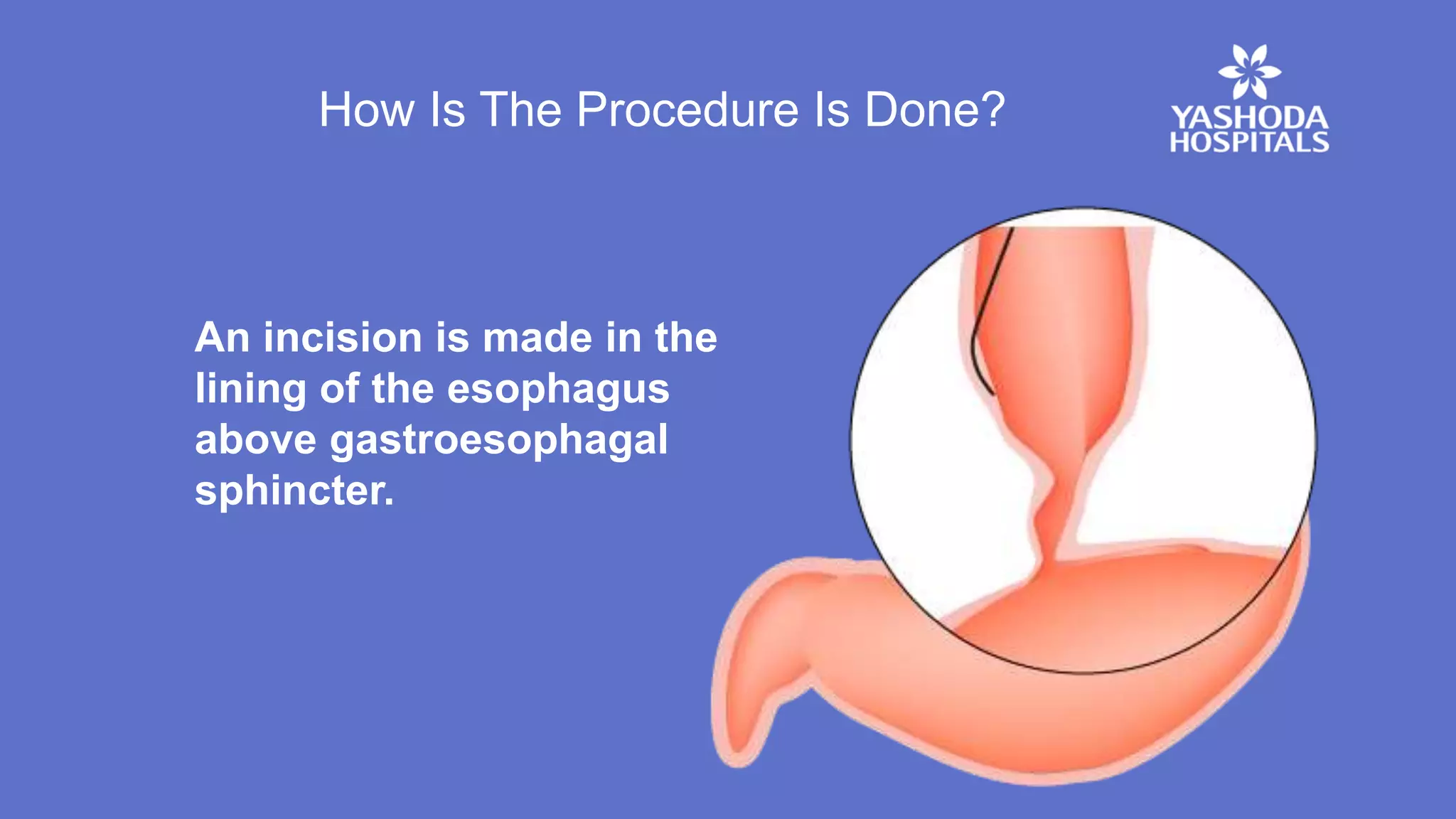 Peroral Endoscopic Myotomy (POEM) | Treatment For Achalasia of ...