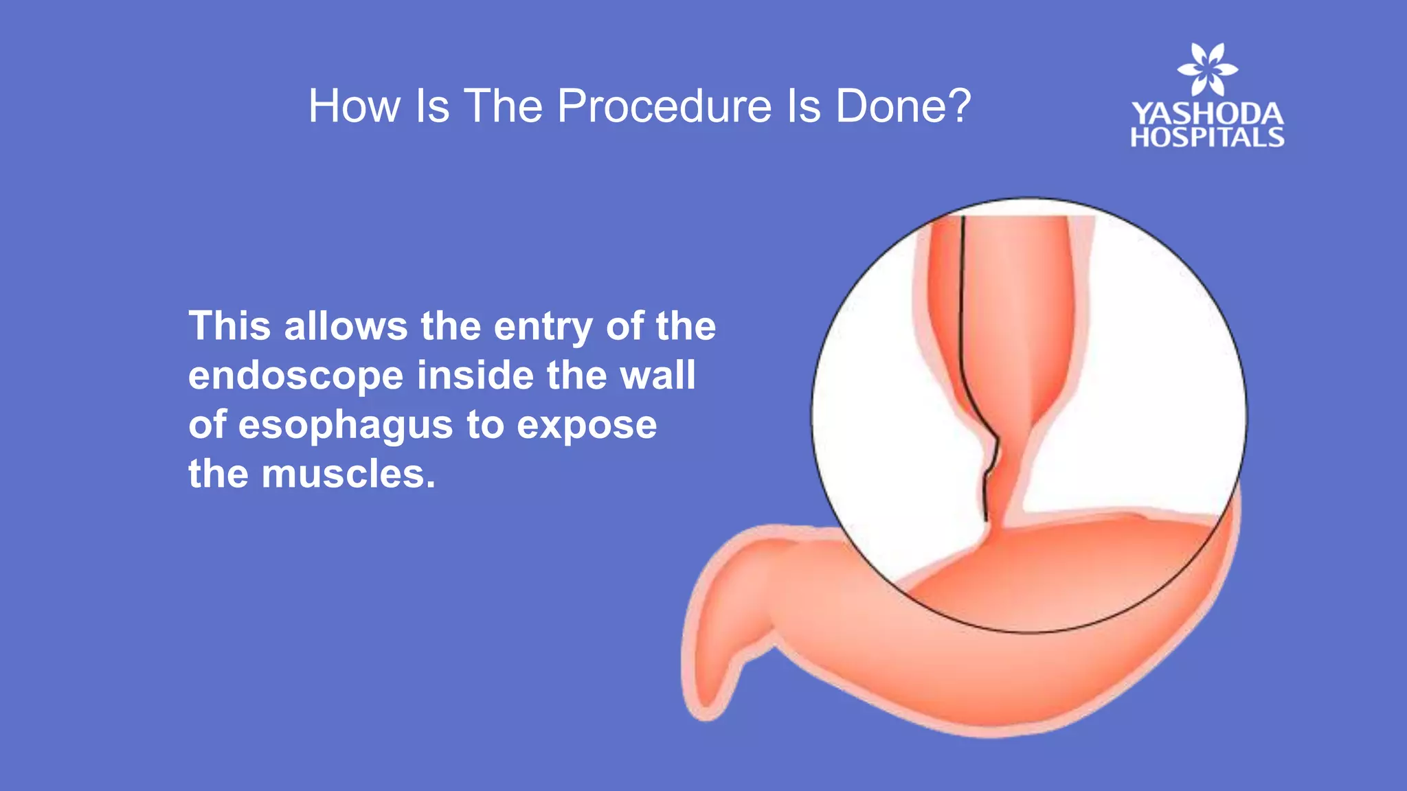 Peroral Endoscopic Myotomy (POEM) | Treatment For Achalasia of ...