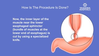 Peroral Endoscopic Myotomy (POEM) | Treatment For Achalasia of ...
