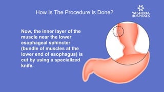 Peroral Endoscopic Myotomy (POEM) | Treatment For Achalasia of ...