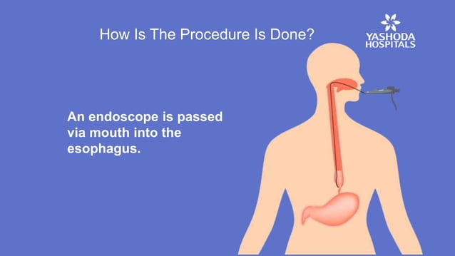 Peroral Endoscopic Myotomy (POEM) | Treatment For Achalasia of ...