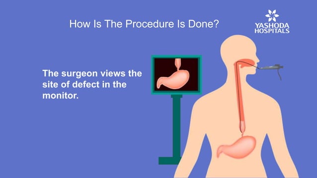 Peroral Endoscopic Myotomy (POEM) | Treatment For Achalasia of ...