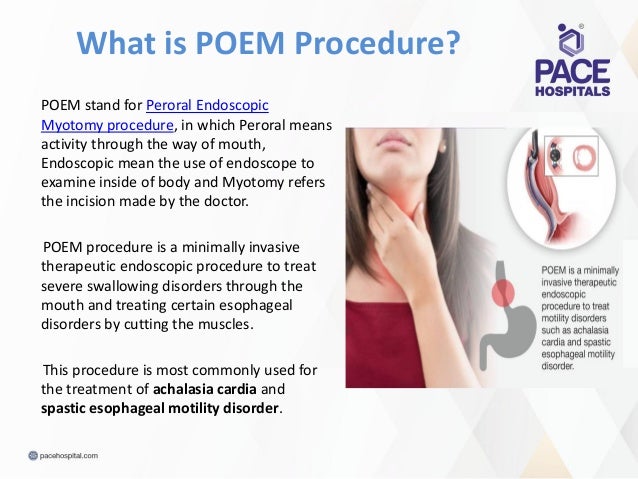 POEM Procedure for Achalasia Cardia - PDF.pdf