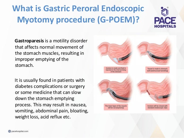 POEM Procedure for Achalasia Cardia - PDF.pdf
