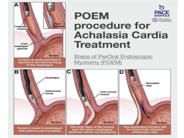 POEM Procedure for Achalasia Cardia - PDF.pdf