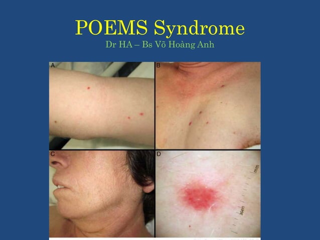 (Dr HA) POEMS Syndrome - Hội chứng POEMS / Bs Võ Hoàng Anh | PPT