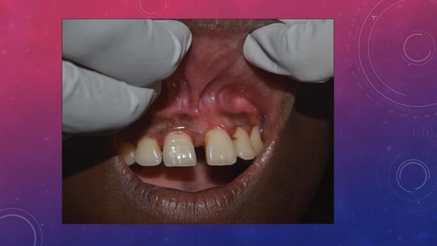 peripheral ossifying fibroma | PPTX | Dental Health | Diseases and ...