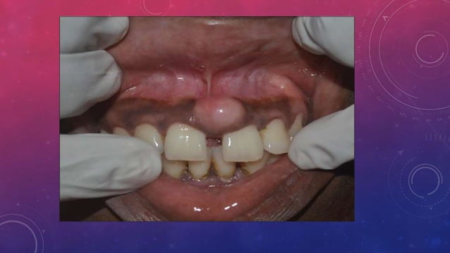 peripheral ossifying fibroma | PPTX | Dental Health | Diseases and ...