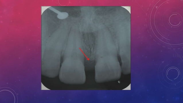 peripheral ossifying fibroma | PPTX | Dental Health | Diseases and ...