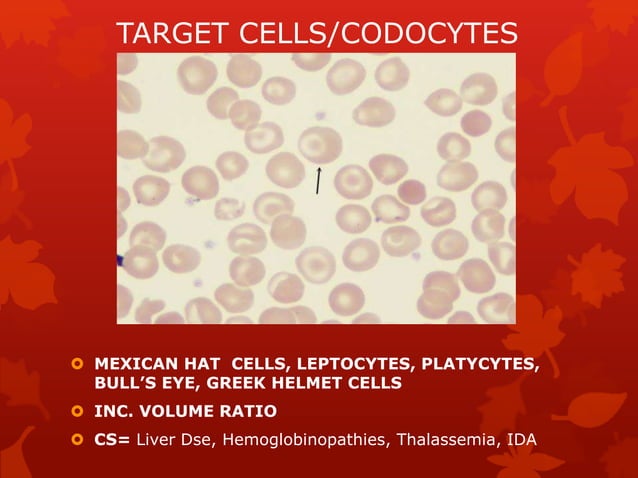 POIKILOCYTOSIS OF RBC | PPTX | Blood Disorders | Diseases and Conditions