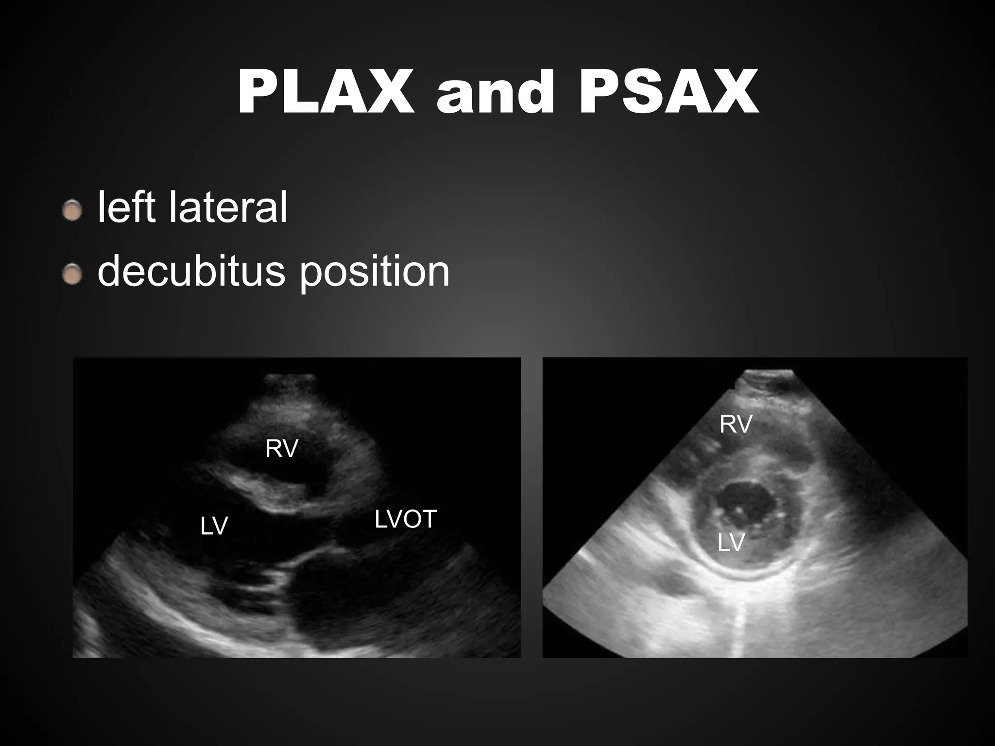 Focused Cardiac Ultrasound | PPTX