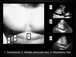 Focused Cardiac Ultrasound | PPTX