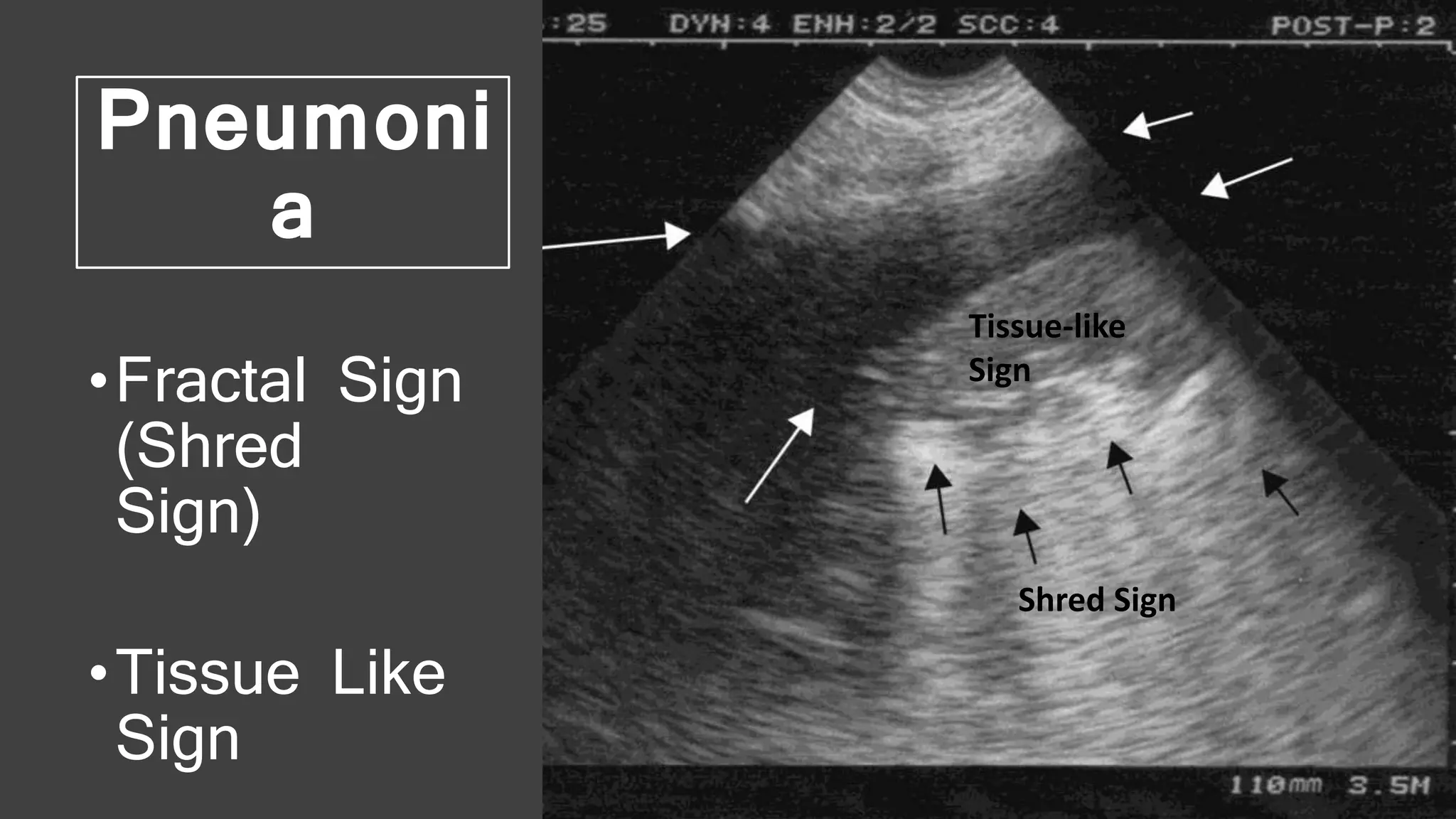 Point of Care Lung Ultrasound | PPTX