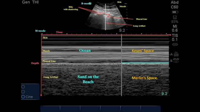 Point Of Care Lung Ultrasound Ppt