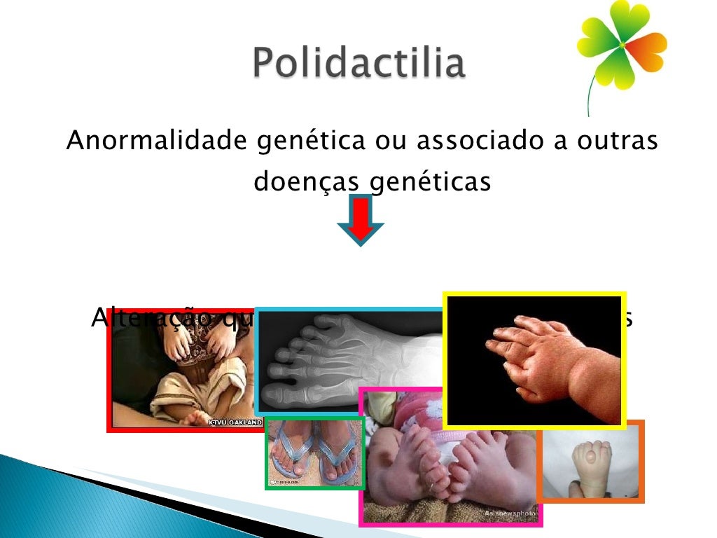 Polidactilia