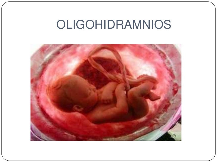 Polihidramnios y oligohidramnios