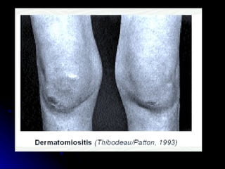 Polimiositis Dermatomiositis | PPT | Medical Health