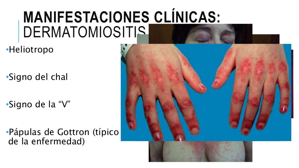 Polimiositis y dermatomiositis