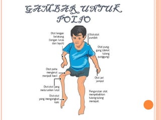Polio | PPT