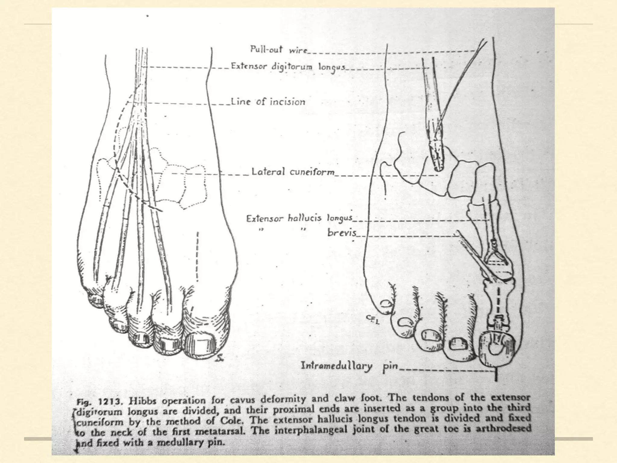 Post polio residual paralysis of foot and ankle | PPTX