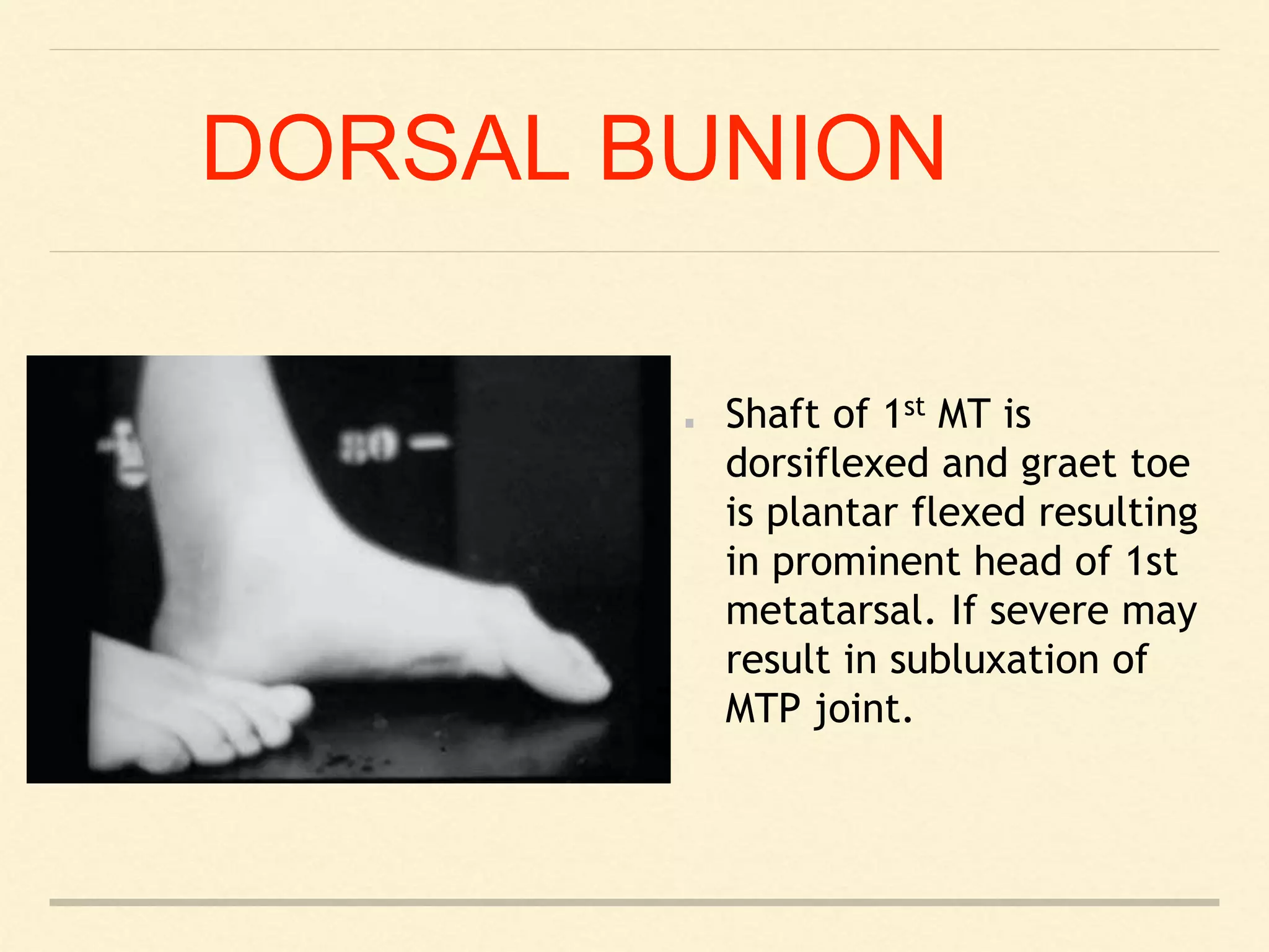 Post polio residual paralysis of foot and ankle | PPTX