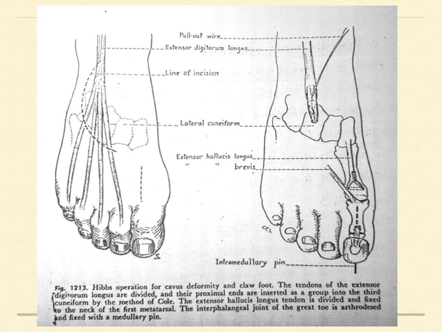 Post polio residual paralysis of foot and ankle | PPTX | Death, Injury ...