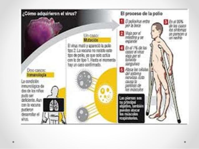 Poliomielitis Causas Sntomas Y Tratamiento