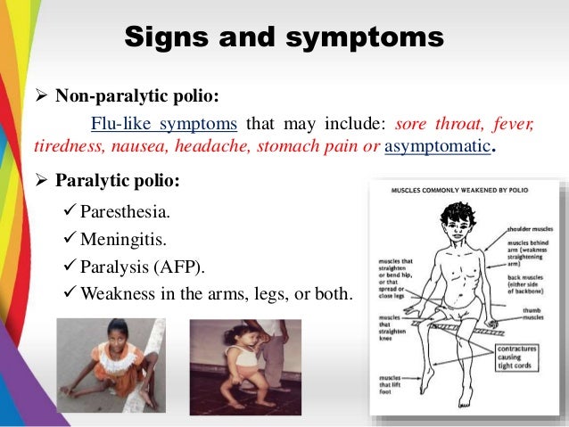 Polio Poliomyelitis
