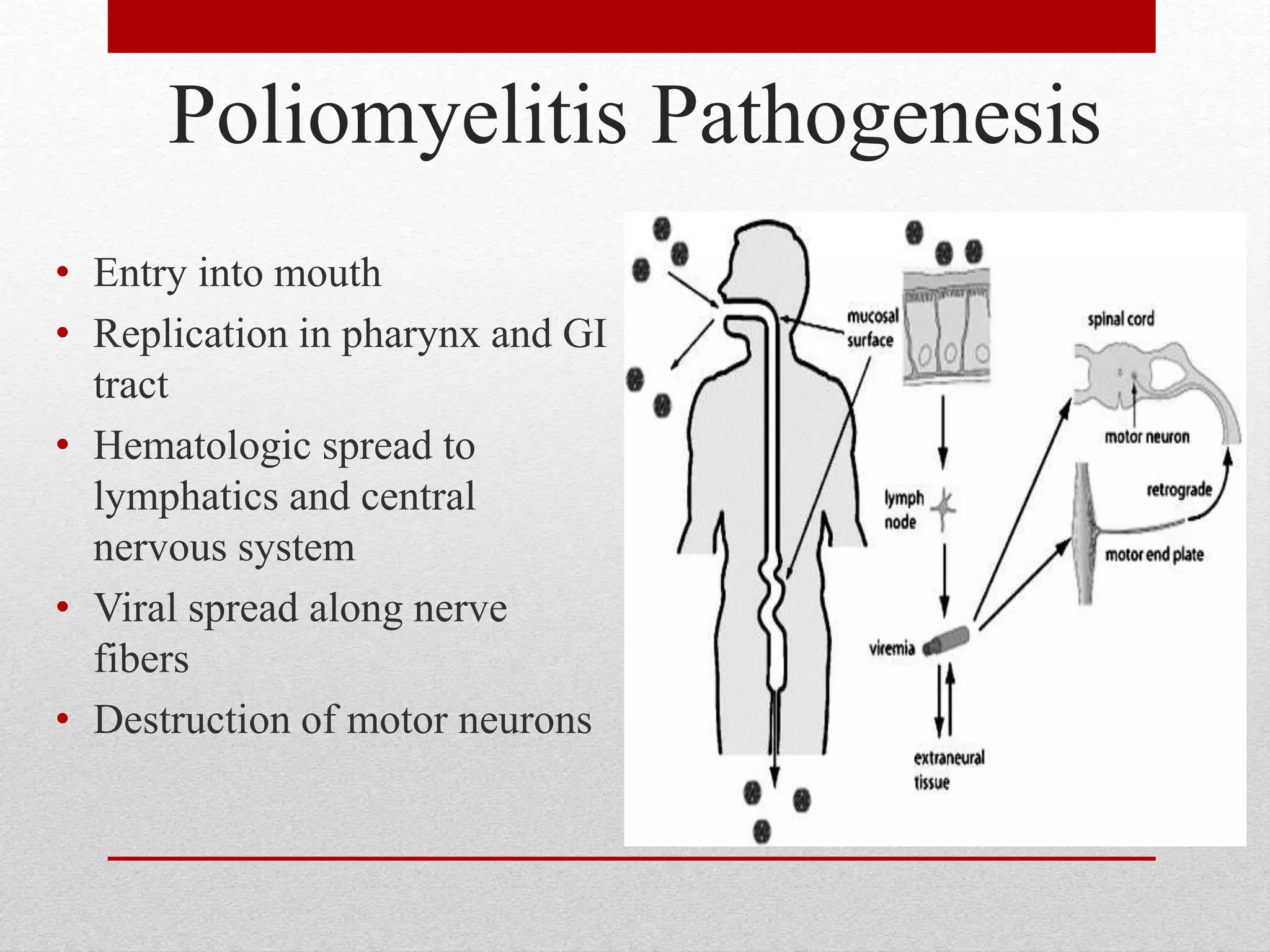 Poliomyelitis & it's Vaccine | PPTX