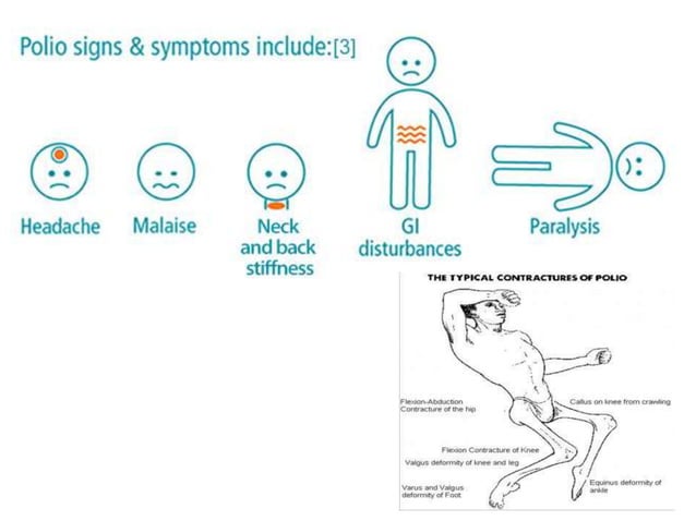 Polio virus notes for MLT students | PPTX