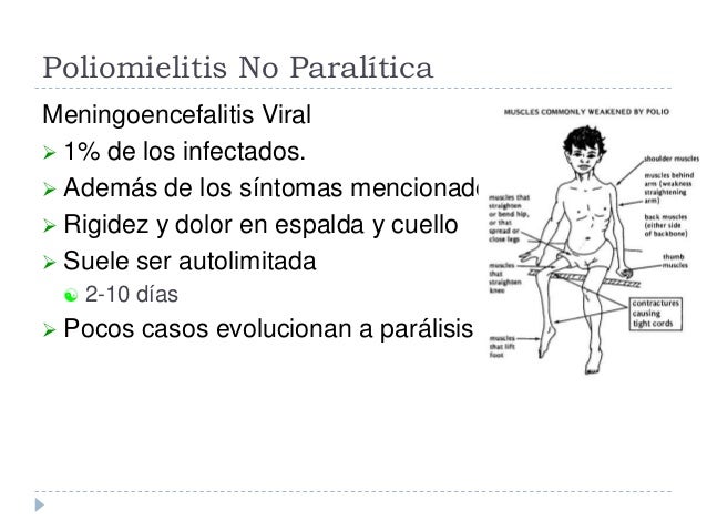 Poliomielitis Causas Sntomas Y Tratamiento