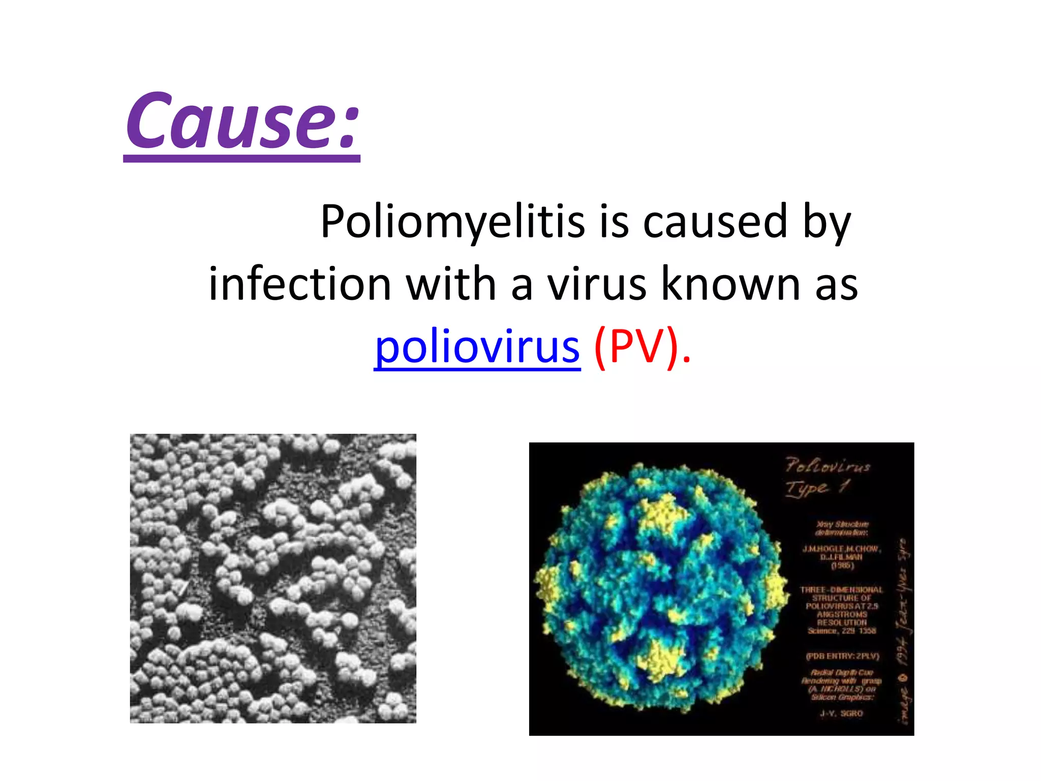 Poliomyelitis | PPT