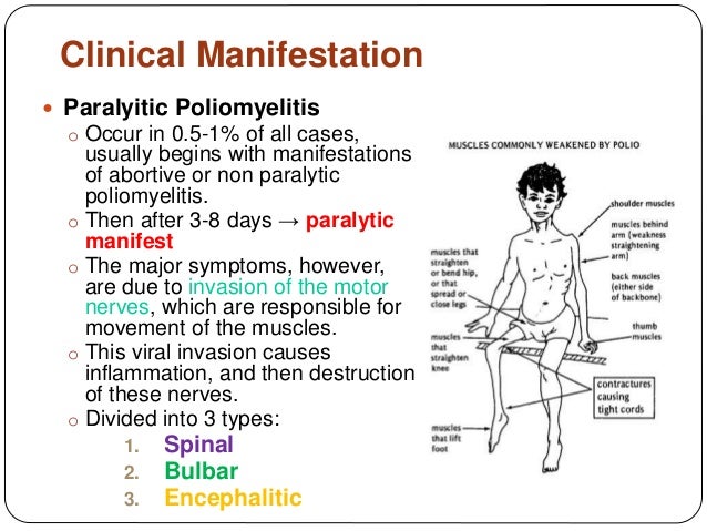 Poliomyelitis