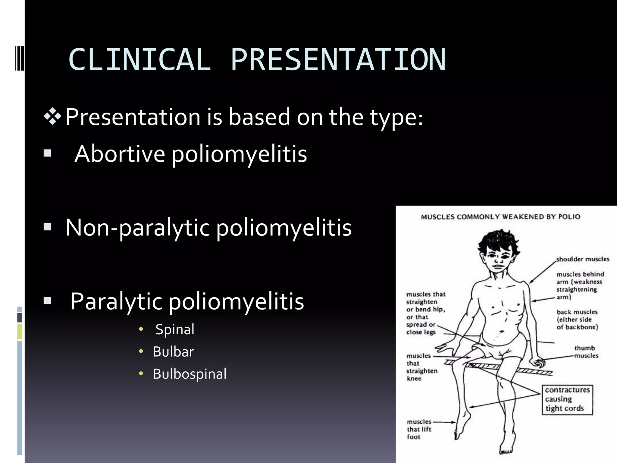 Poliomyelitis | PPTX