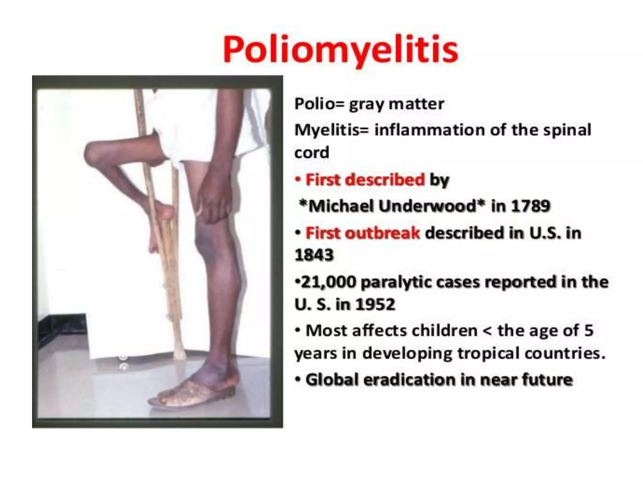 Poliomyelitis | PPTX