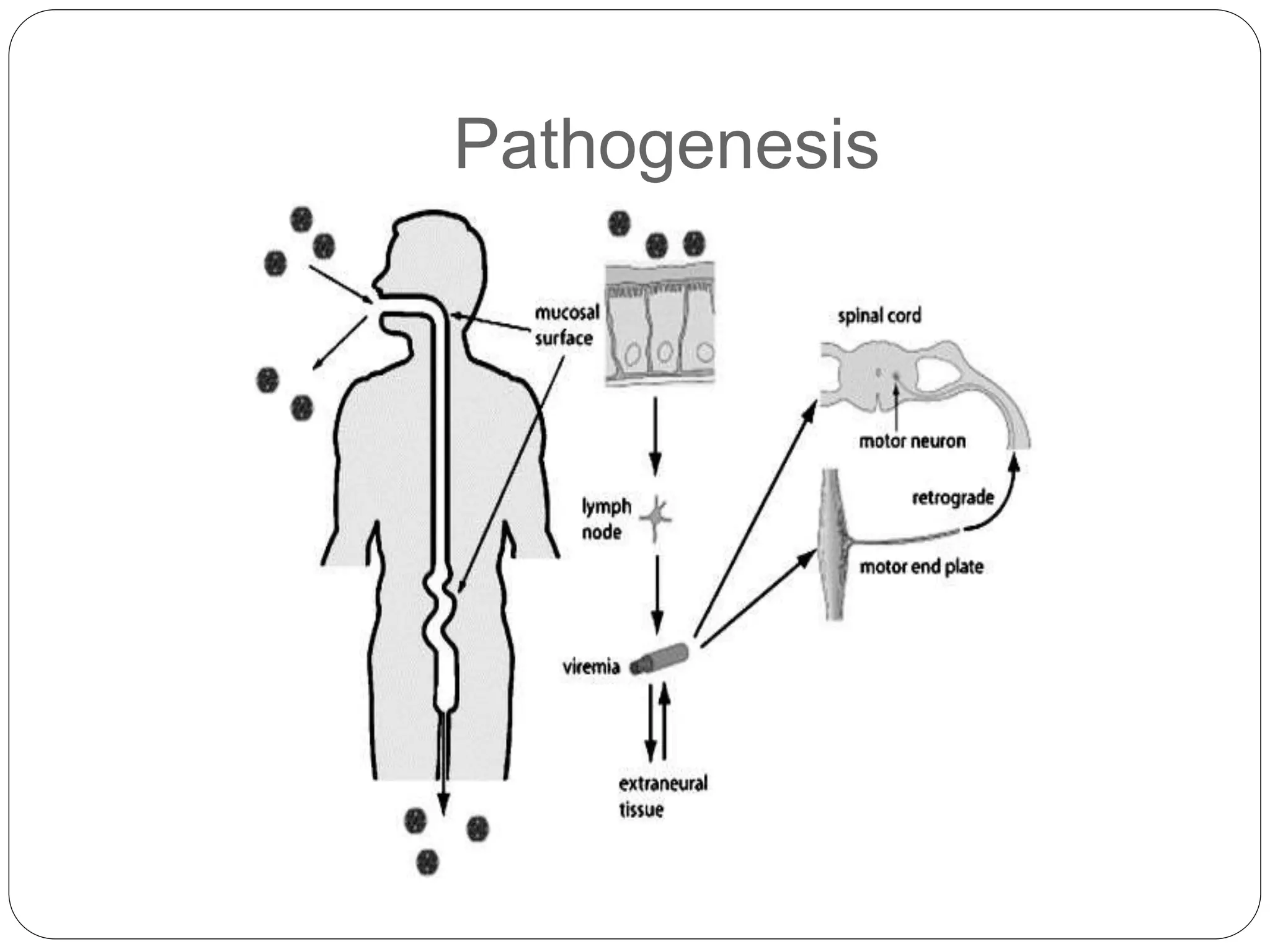 Poliomyelitis | PPTX