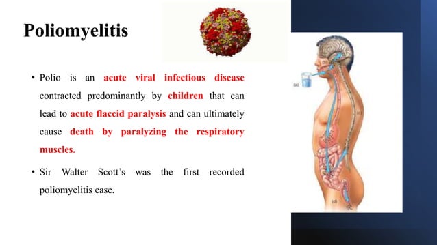 Poliomyelitis.pptx