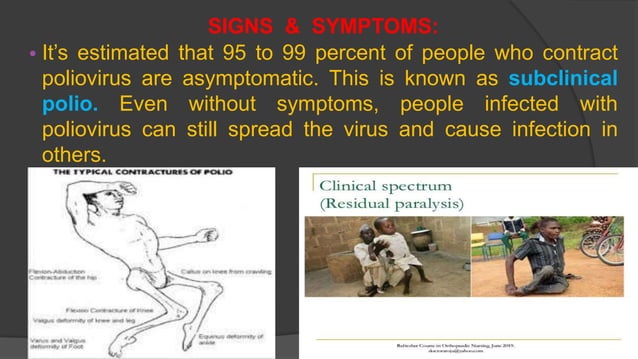 poliomyelitis for community health nursing | PPTX