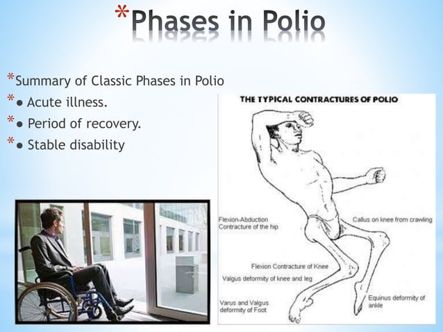 Poliomyelitis and post polio syndrome | PPTX | Brain and Nervous System ...