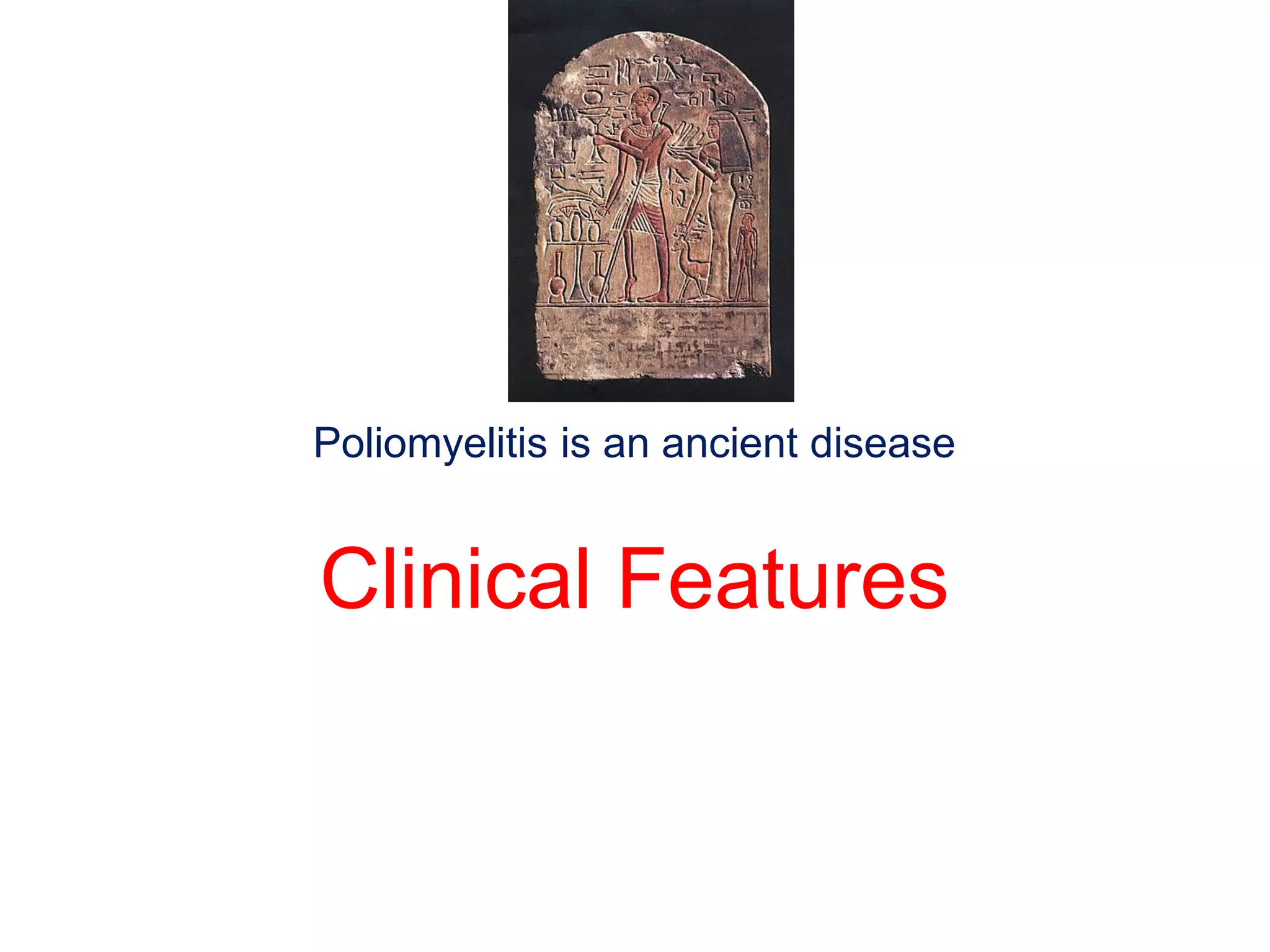 Poliomyelitis in children 2021 | PDF