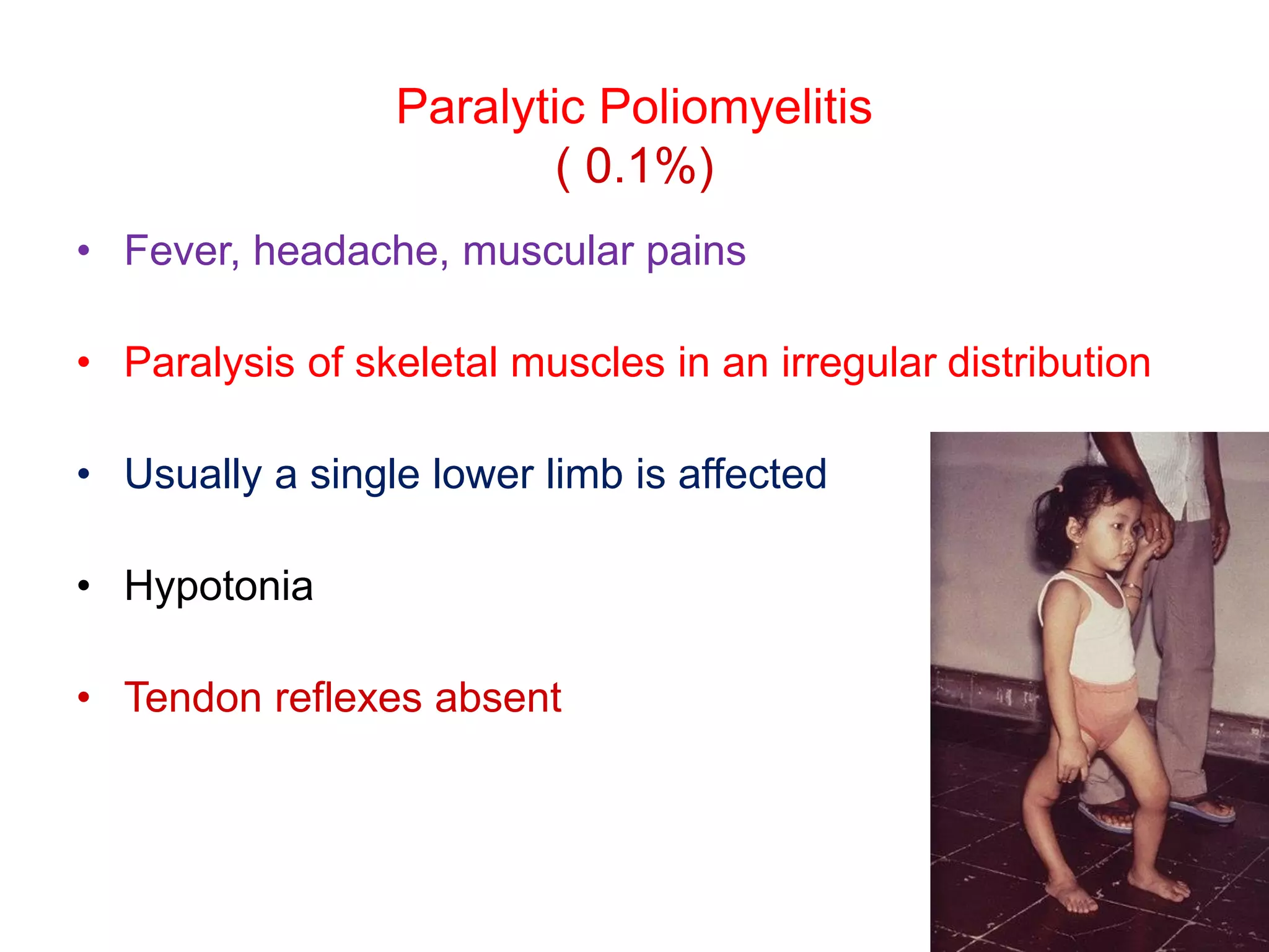 Poliomyelitis in children 2021 | PDF