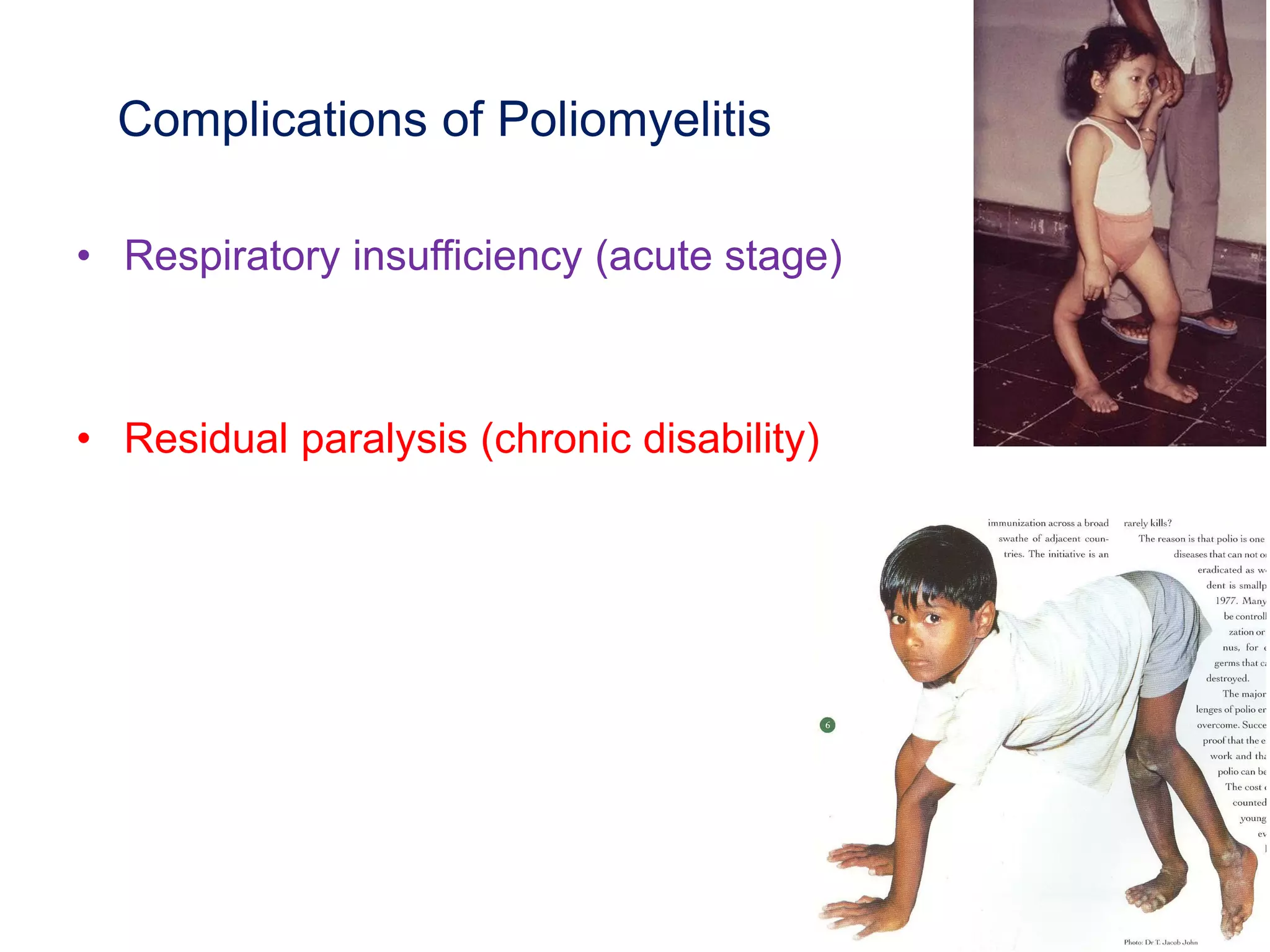 Poliomyelitis in children 2021 | PDF