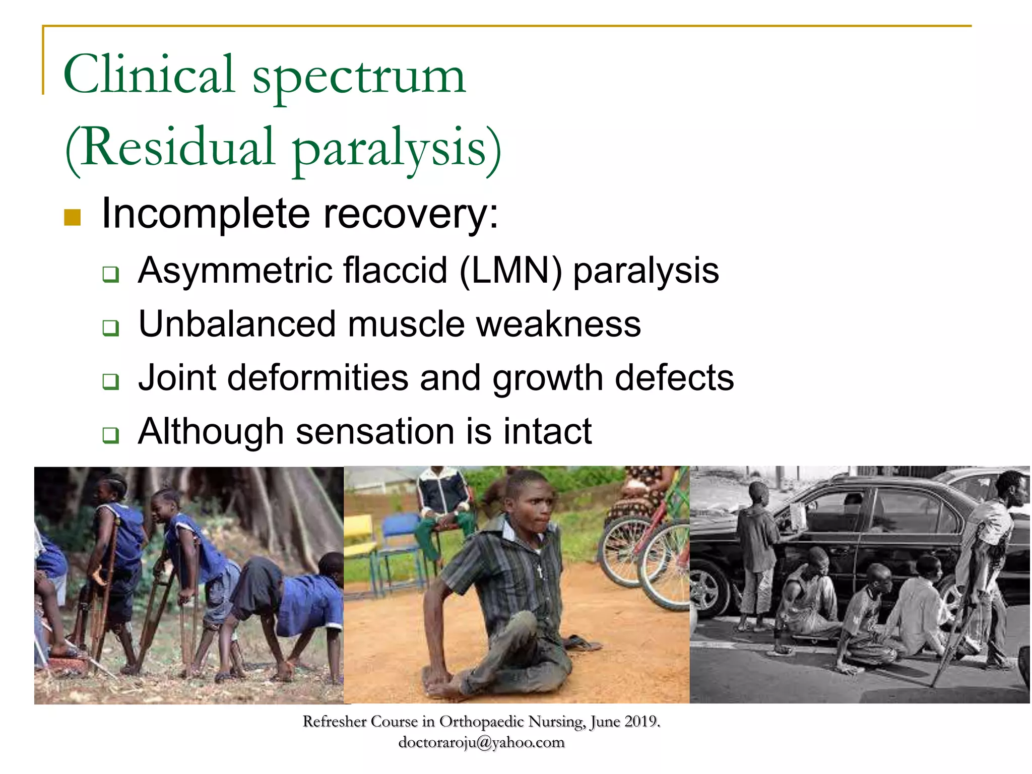 Poliomyelitis and its management | PPTX