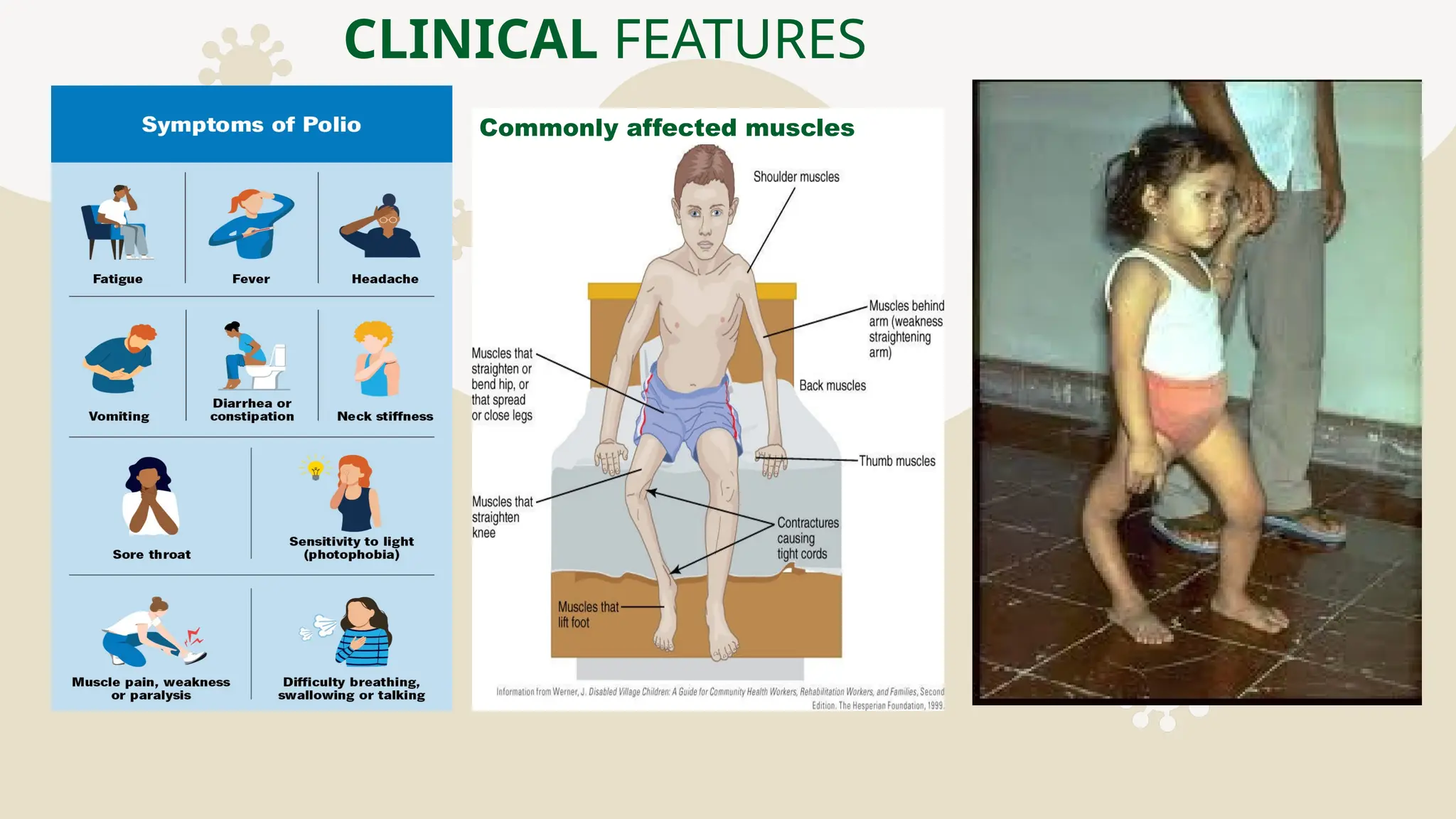 POLIOMYELITIS in children epidemologoy and prevention | PPT