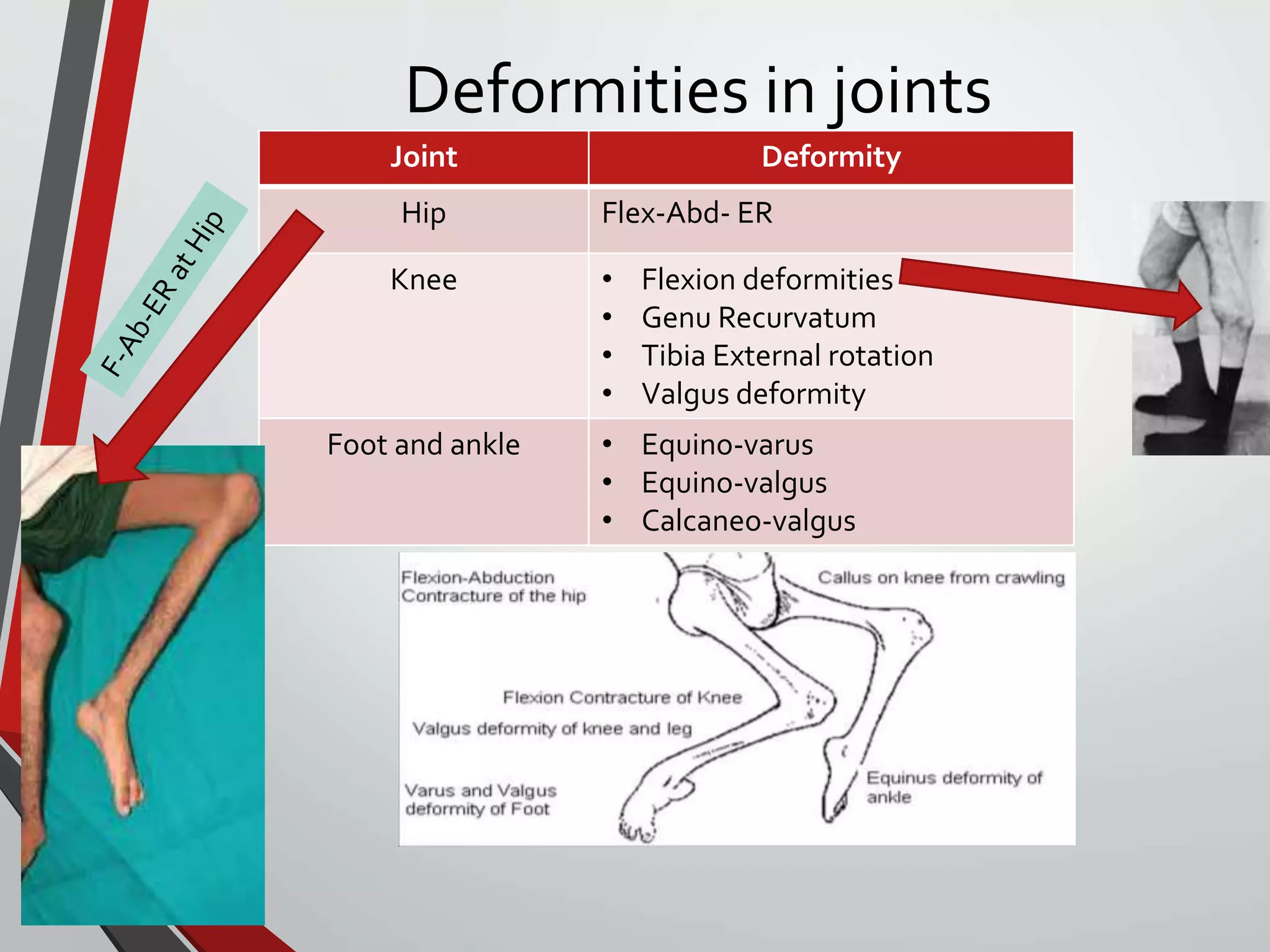 Orthopaedic aspects of Poliomyelitis for MBBS | PPTX