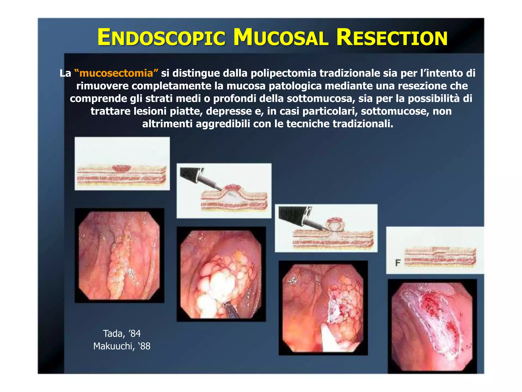 Polipectomia endoscopica | PPSX