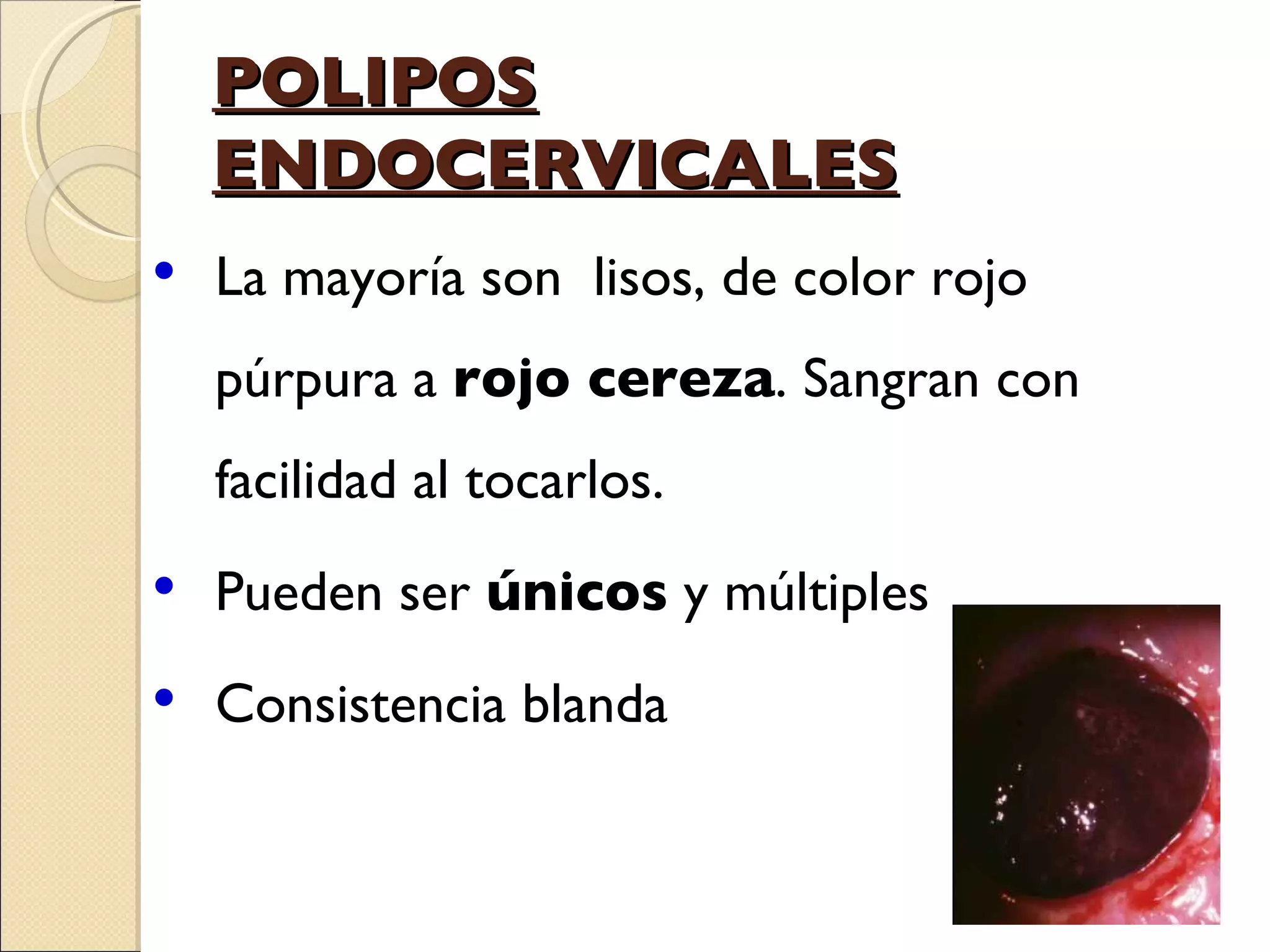 Polipos endometriales y endocervicales | PPT