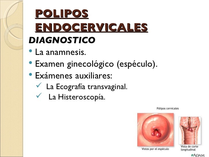 Polipos endometriales y endocervicales