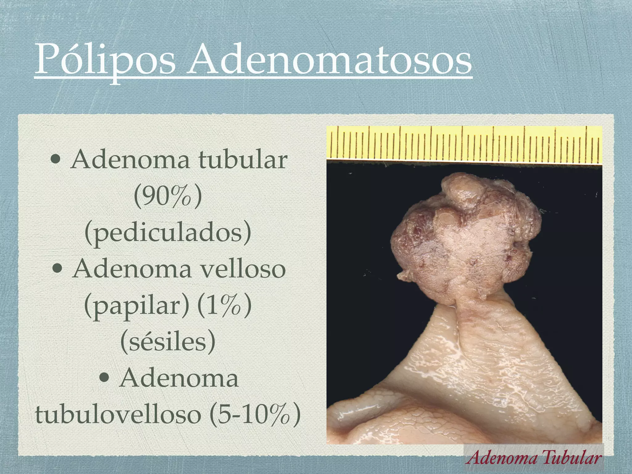 Pólipos de Colon y Recto | PDF