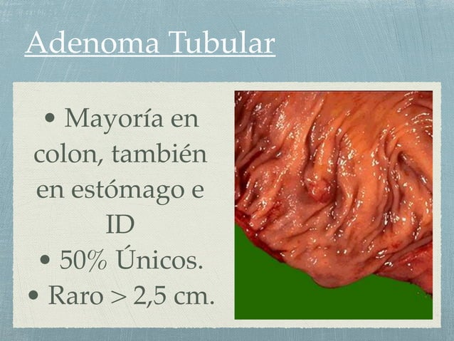 Pólipos de Colon y Recto | PPT | Descarga Gratuita